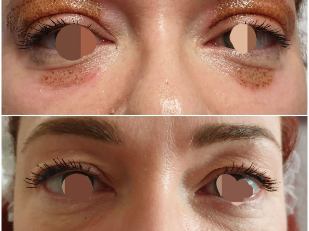ANAIΜΑΚΤΗ ΒΛΕΦΑΡΟΠΛΑΣΤΙΚΗ με PLEXR – LASER DERMA MED